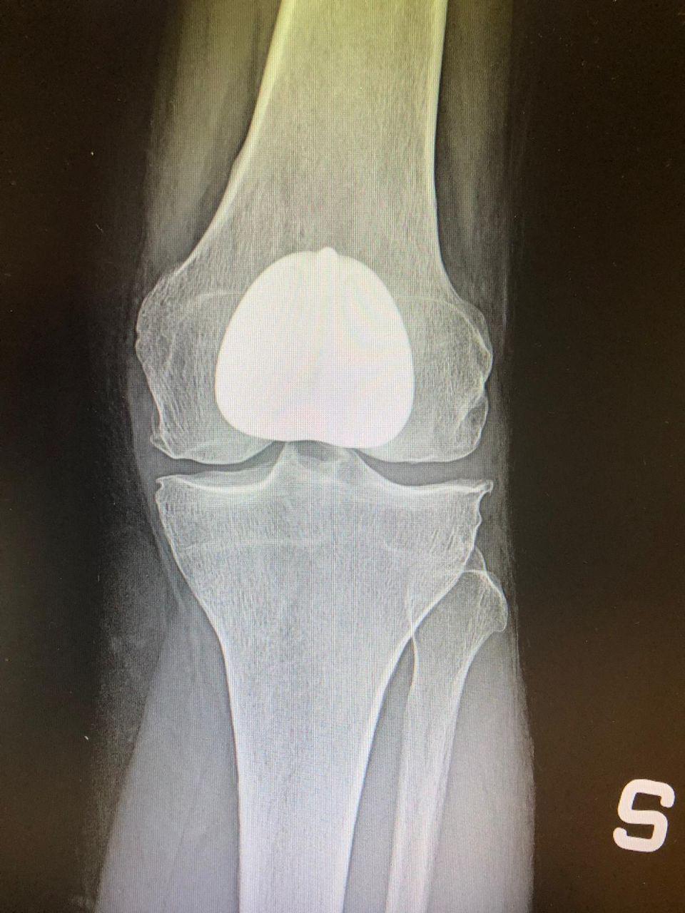 Protesi ginocchio Patient Specific: workflow e principali vantaggi ...