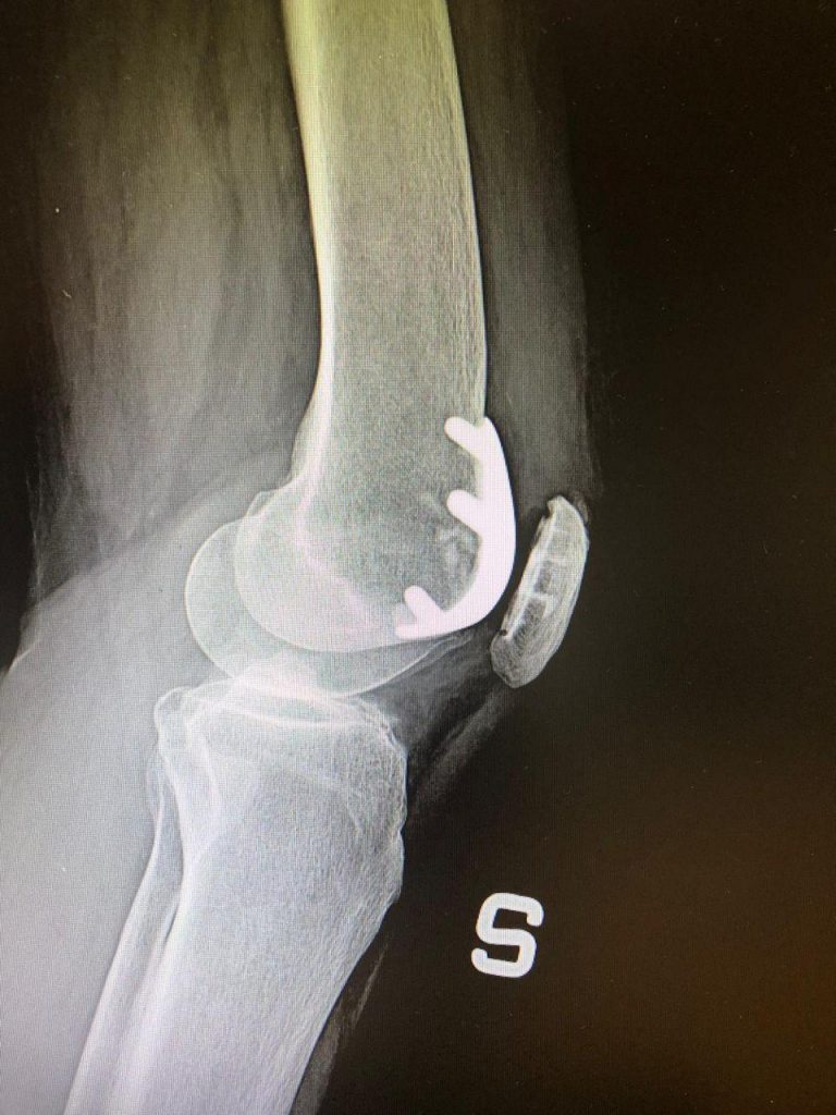 Protesi ginocchio Patient Specific: workflow e principali vantaggi ...